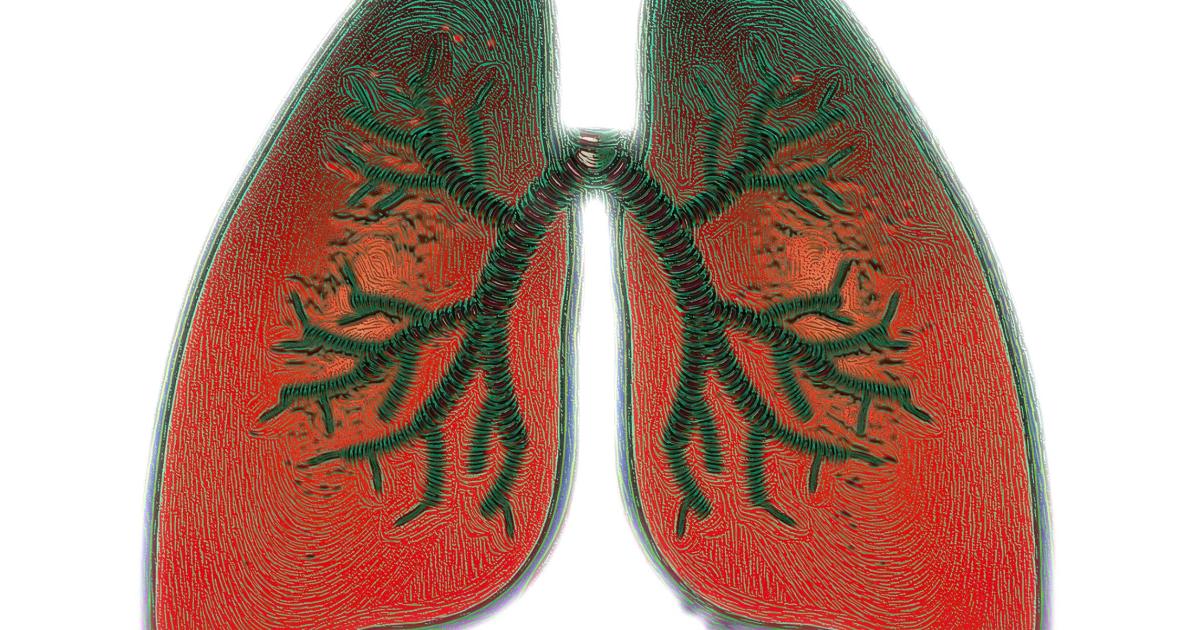 Digital biomarker tool for rapidly identifying lung fibrosis cleared by FDA