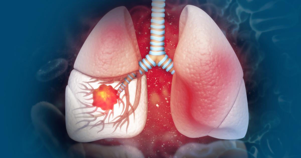 Deep learning helps radiologists target missed lung cancer diagnoses on ...