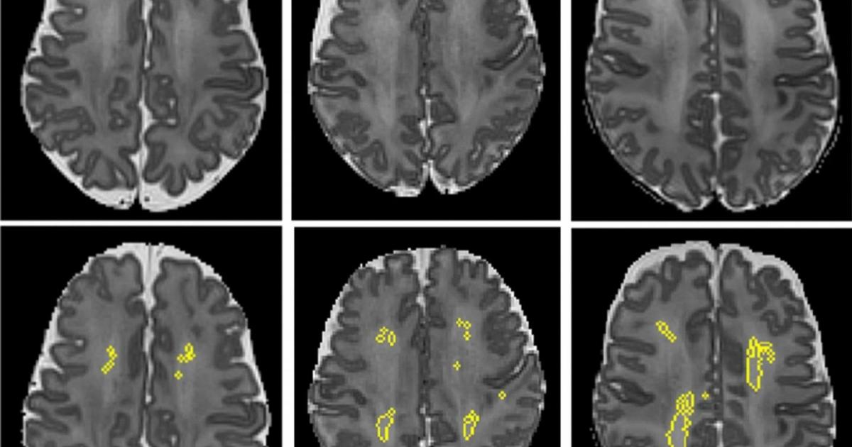 Wearable MRI helmet makes brain scans quicker, quieter and crisper