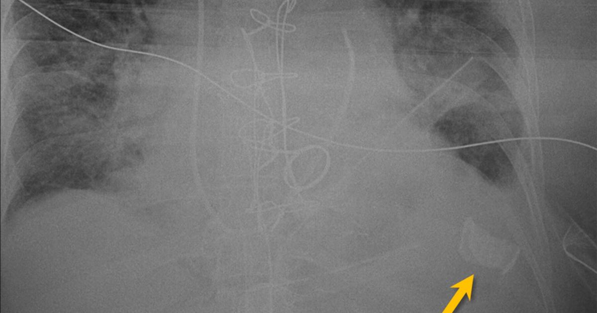What radiologists should know about spotting items left in patients ...
