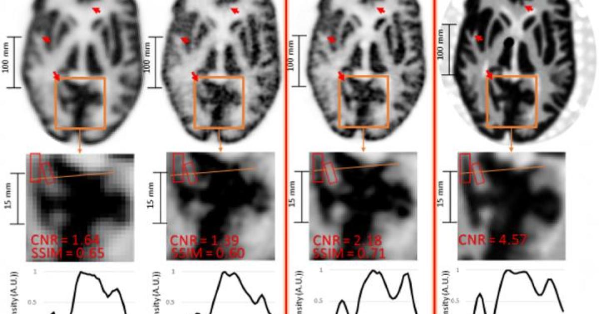 ‘Super-resolution’ PET utilizes unwanted movements to bolster brain imaging