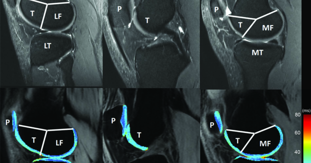 Performing serial MRIs in young patients with hemophilia may spot early ...