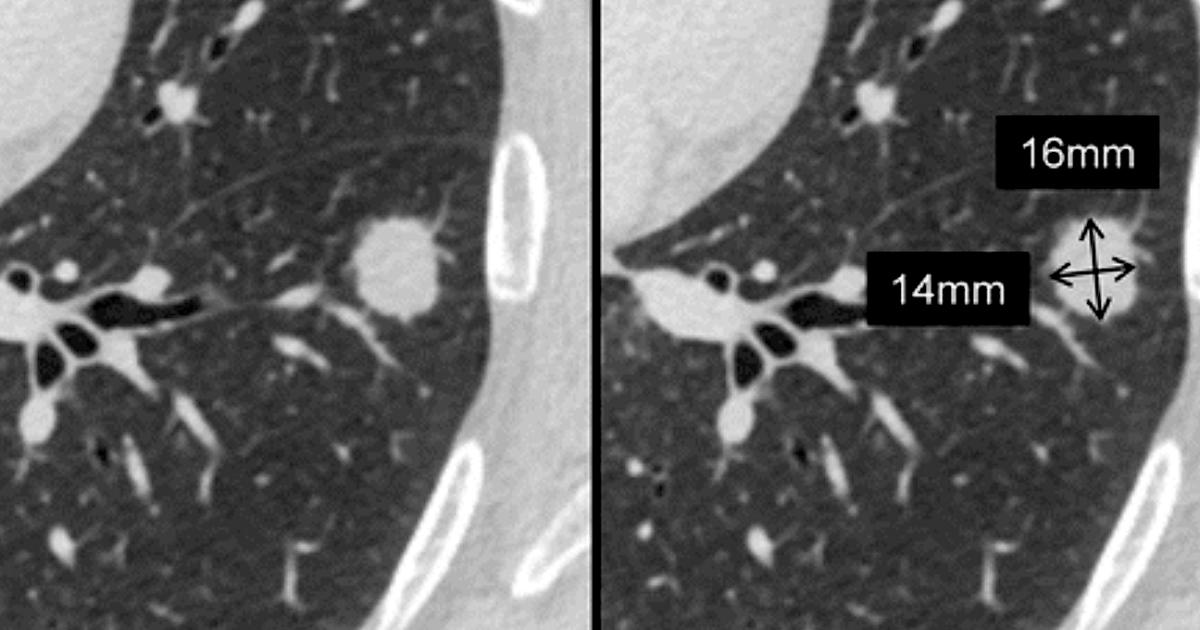 ACR outlines changes in Medicare lung cancer screening coverage