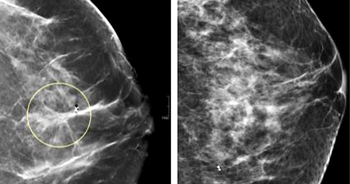 abnormal mammogram r92 8