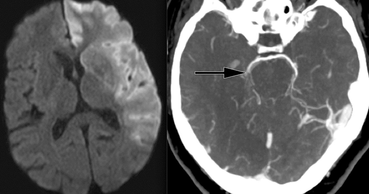 stroke ct scan normal