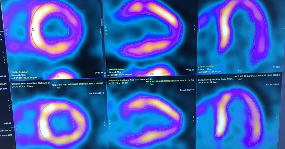 Siemens debuts new, cleared SPECT/CT model