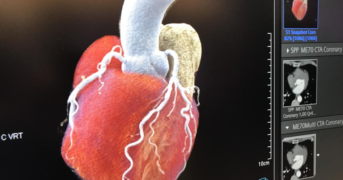 VIDEO: Example of photo-counting cardiac CT with calcified coronaries