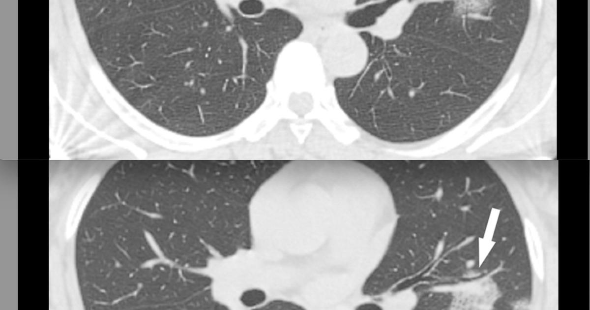 How effective are chest CT severity scores in managing COVID?