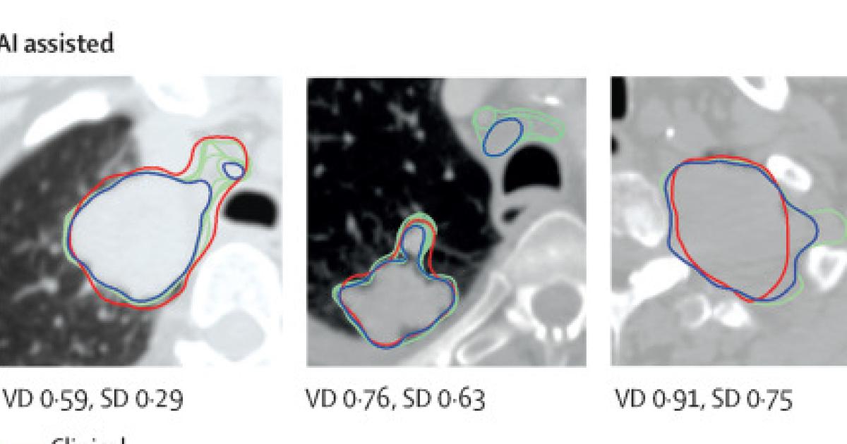 Algorithm reduces NSCLC tumor segmentation times by 65%