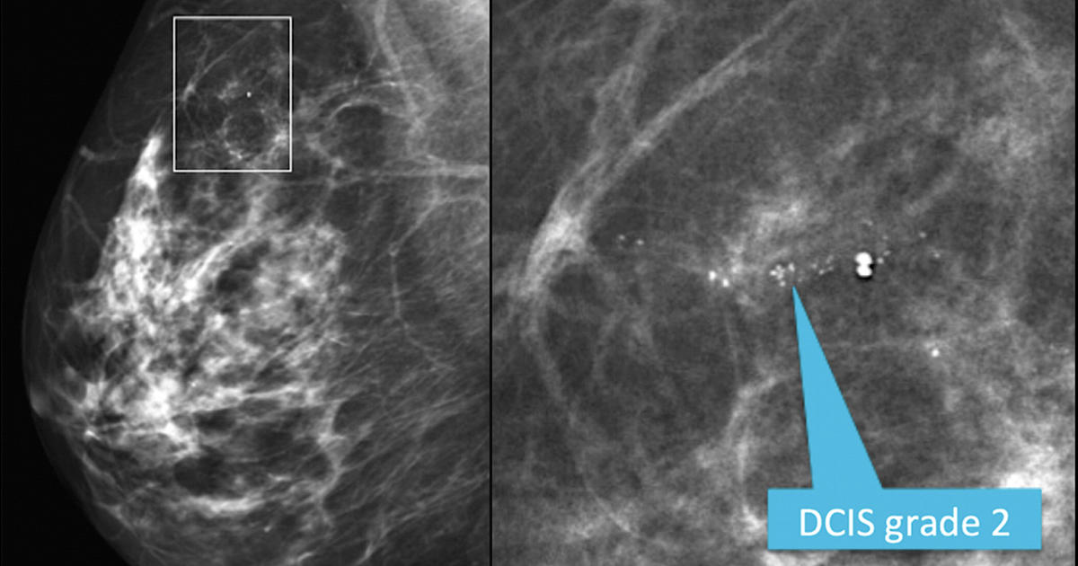 Why the way microcalcifications on mammograms are regarded could change