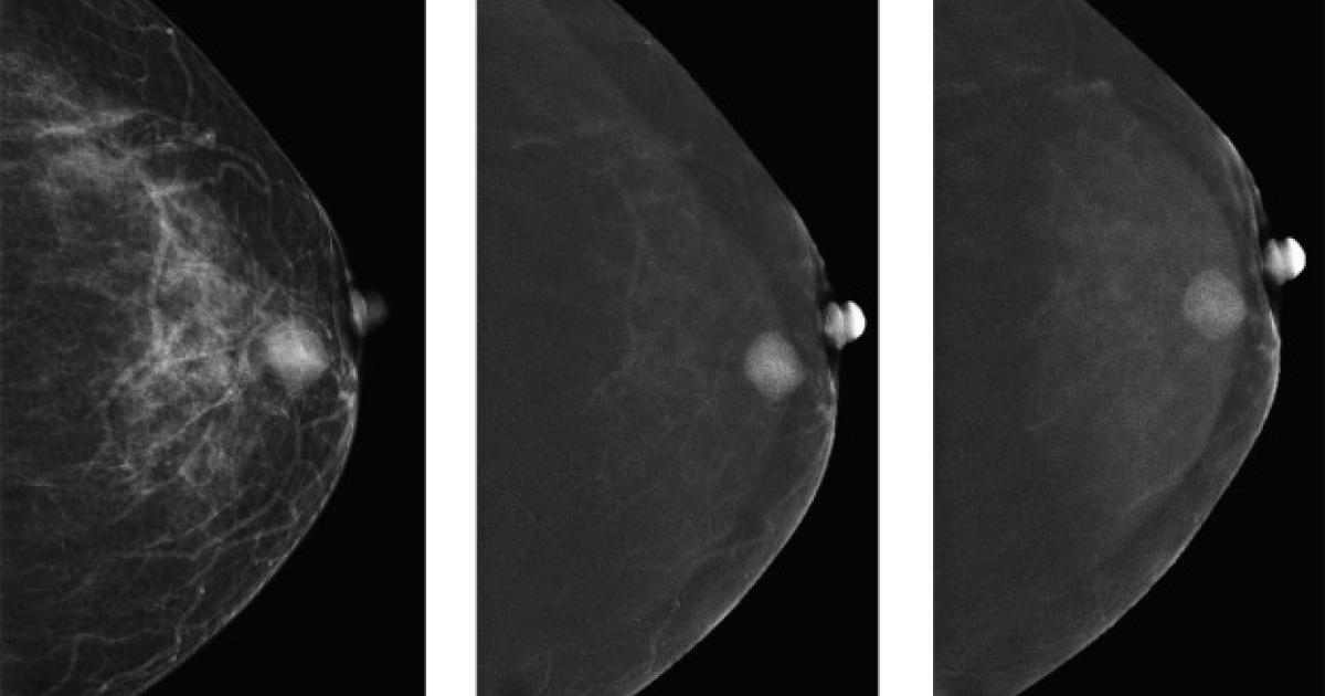 Scoring system outperforms BI-RADS assessments of contrast-enhanced ...