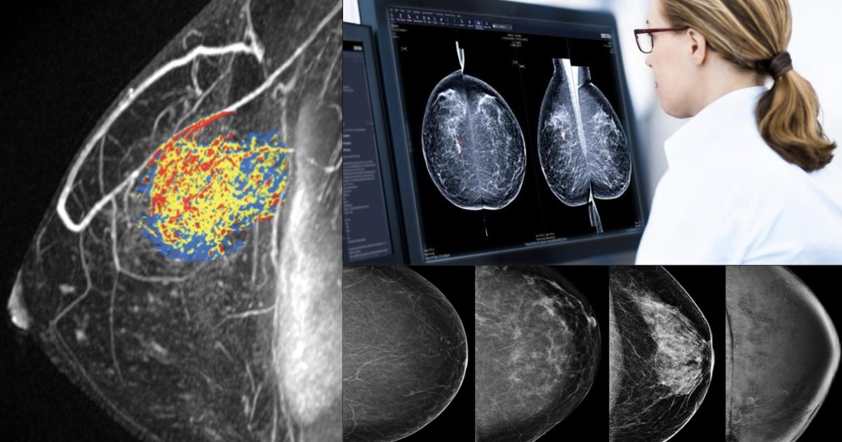 PHOTO GALLERY: What does breast cancer look like on mammography