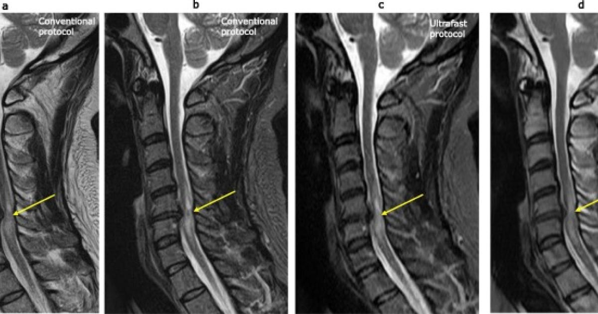 Ultrafast MRI protocol reduces scan time by 10 minutes for cervical imaging