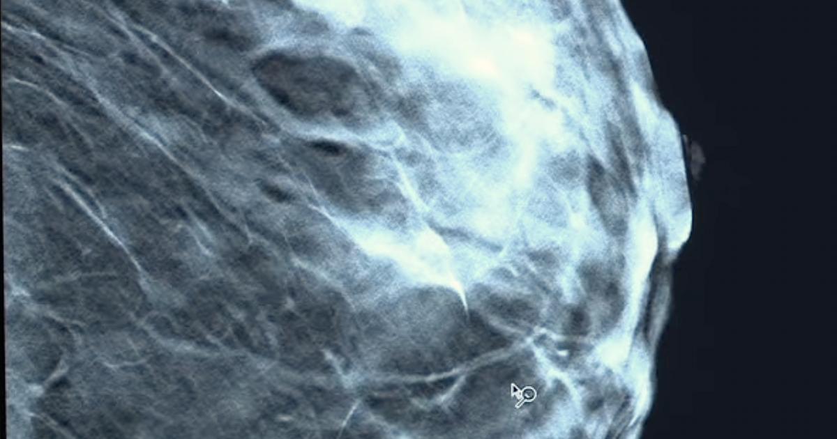 VIDEO: 3D mammography is becoming the standard-of-care in breast imaging