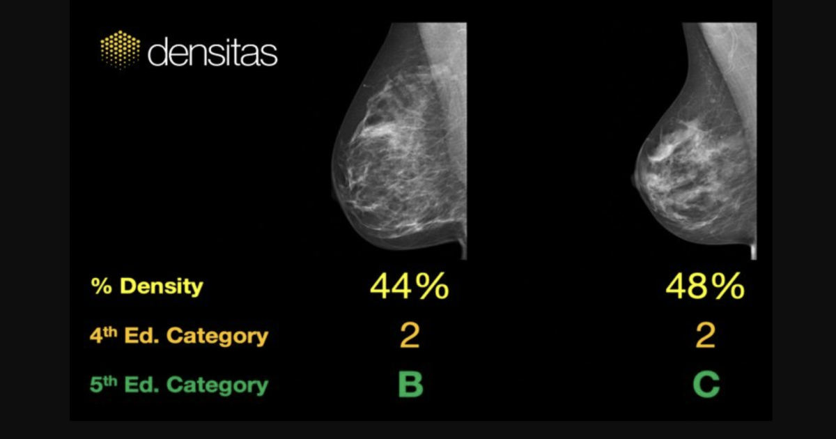 VIDEO: Role of AI in breast imaging with radiomics, detection of breast ...