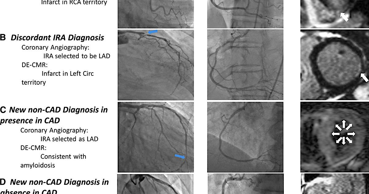 Is MRI better than angiography for diagnosing, treating certain heart ...