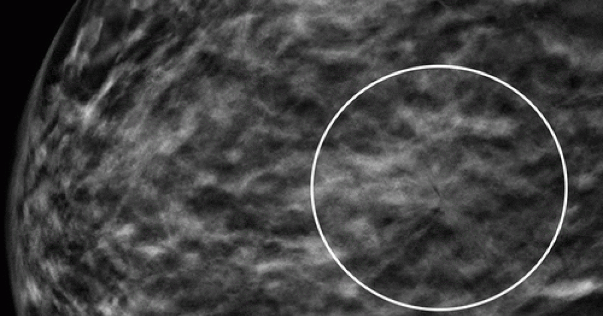 Women with extremely dense breasts benefit most from DBT plus ...