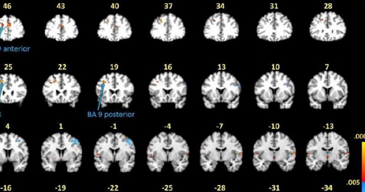 MRI shows structural, functional brain abnormalities in Lyme disease ...