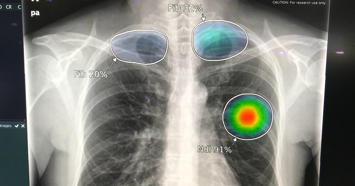 PHOTO GALLERY: Examples of FDA-cleared AI in radiology