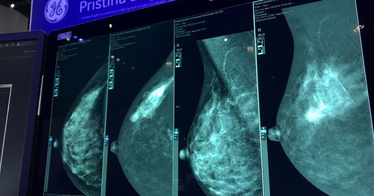 ACR CEO outlines top trends in breast imaging