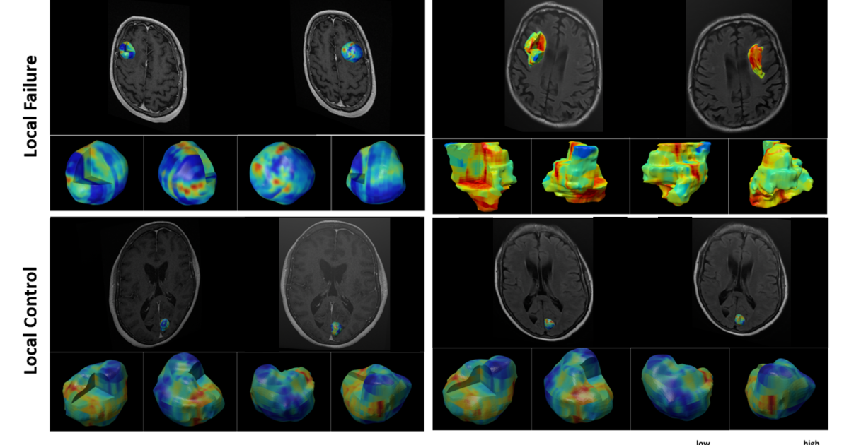 Ai Bests Humans At Predicting Outcomes For Brain Radiotherapy Patients