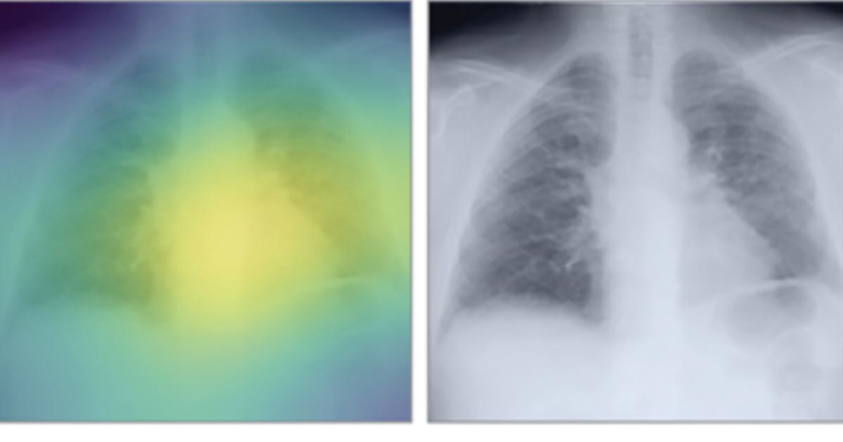 VIDEO: AI predicts heart disease risk using single chest X-ray
