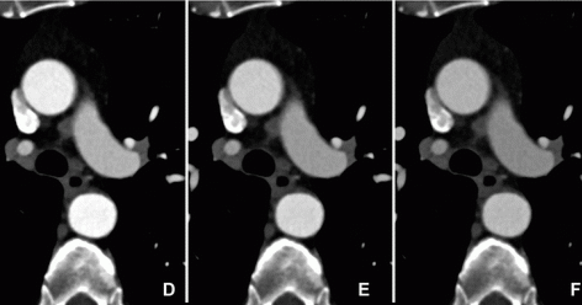 Photon counting cuts CTA contrast dosage 25%