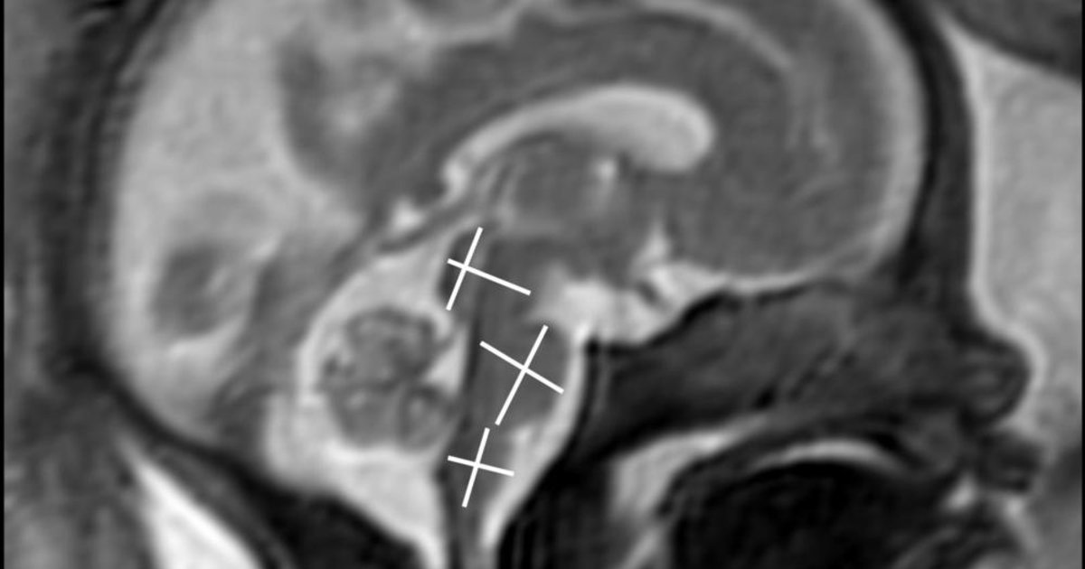 Fetal MRI safe on 3T scanners, new analysis shows