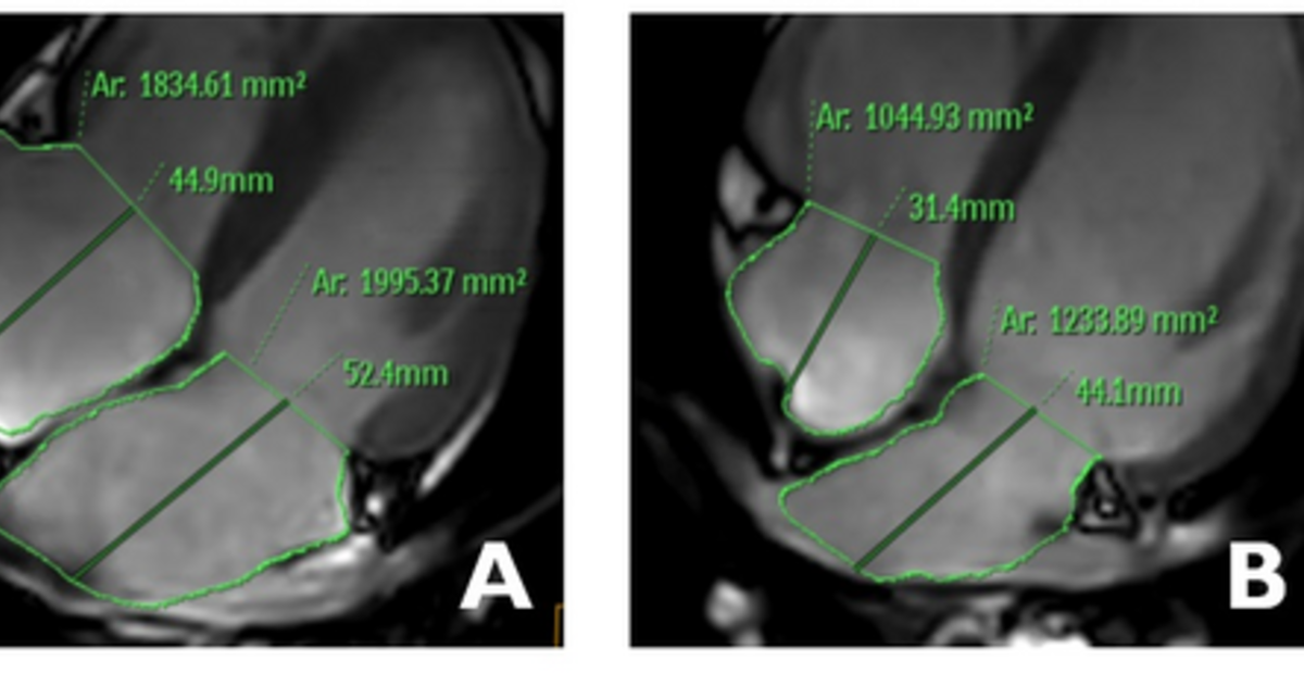 Experts develop cardiac MRI reference values for healthy adolescents