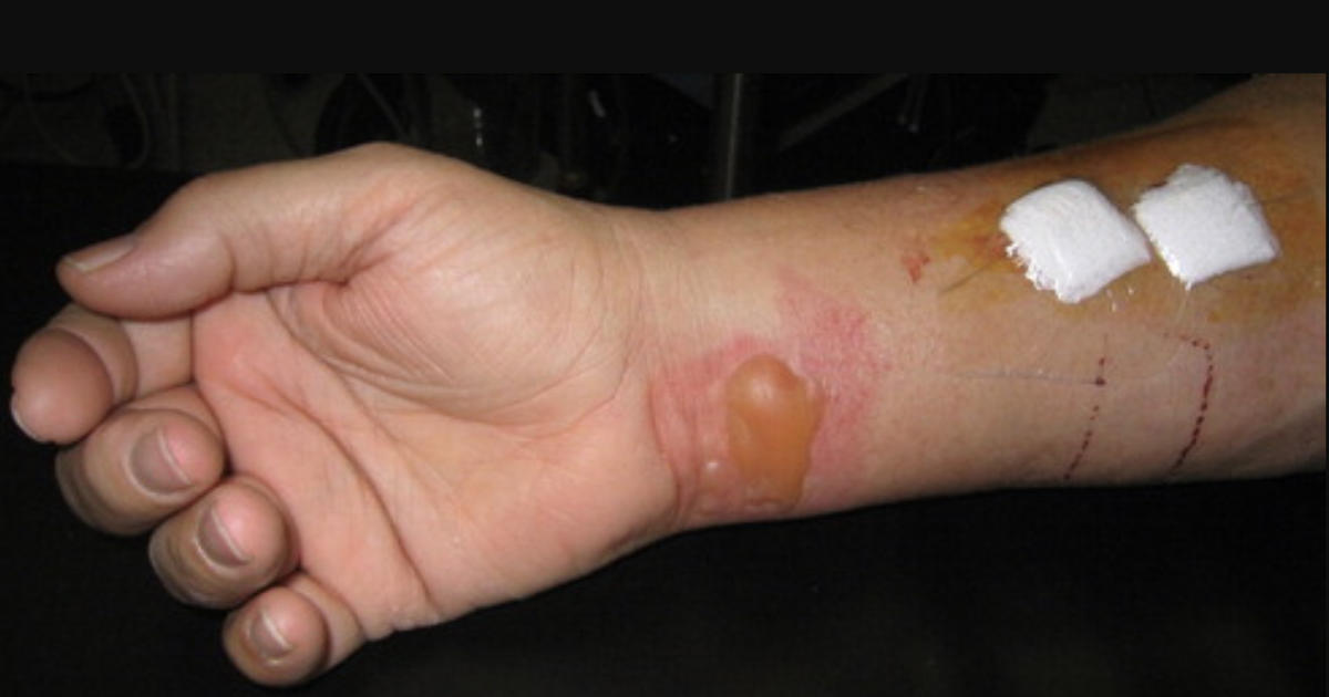 Battling Burns in MRI