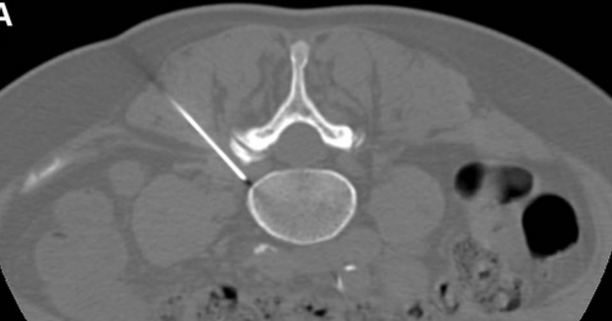 Pulsed radiofrequency procedure could help patients avoid surgery for sciatica
