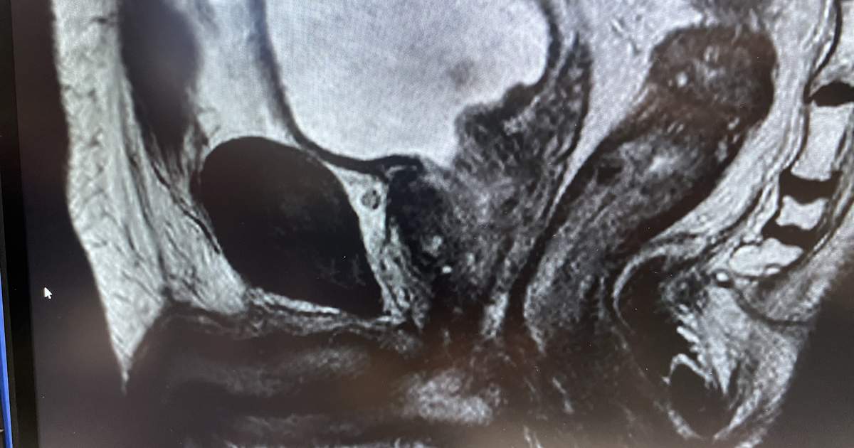 MRI scans deliver value as a primary screening tool for prostate cancer