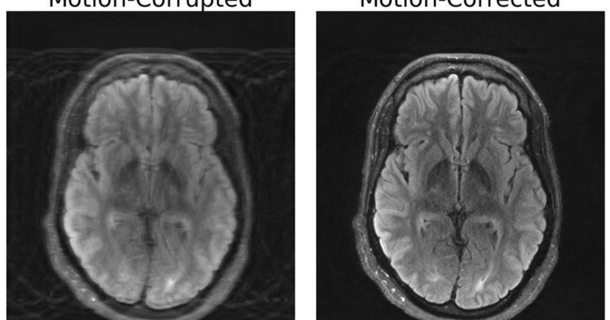 MRI results affected by movement? MIT researchers have an AI-powered ...