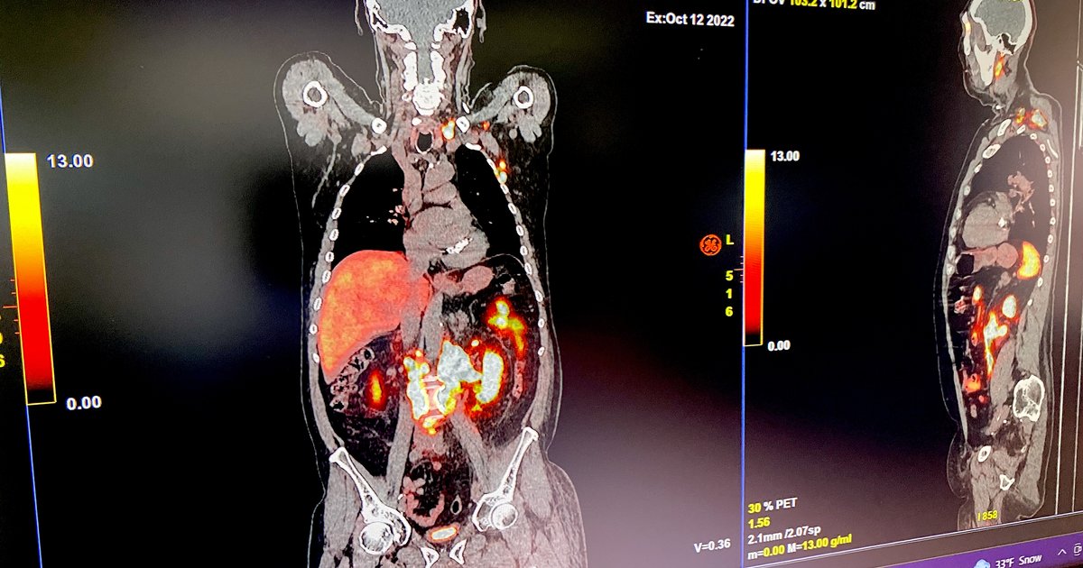 PSMA PET/CT shows promise for spotting metastatic disease in patients with renal cell carcinoma