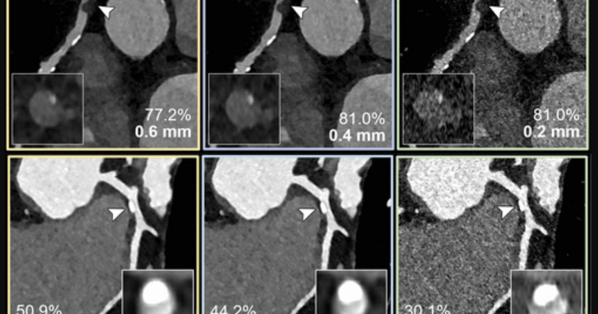 Coronary artery disease classification improved with photon-counting CT
