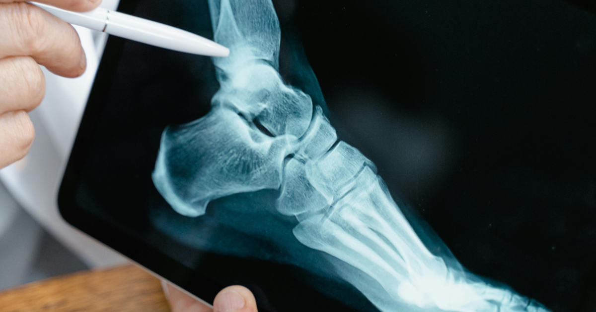 AI model for ankle stress radiography could reduce radiologists ...