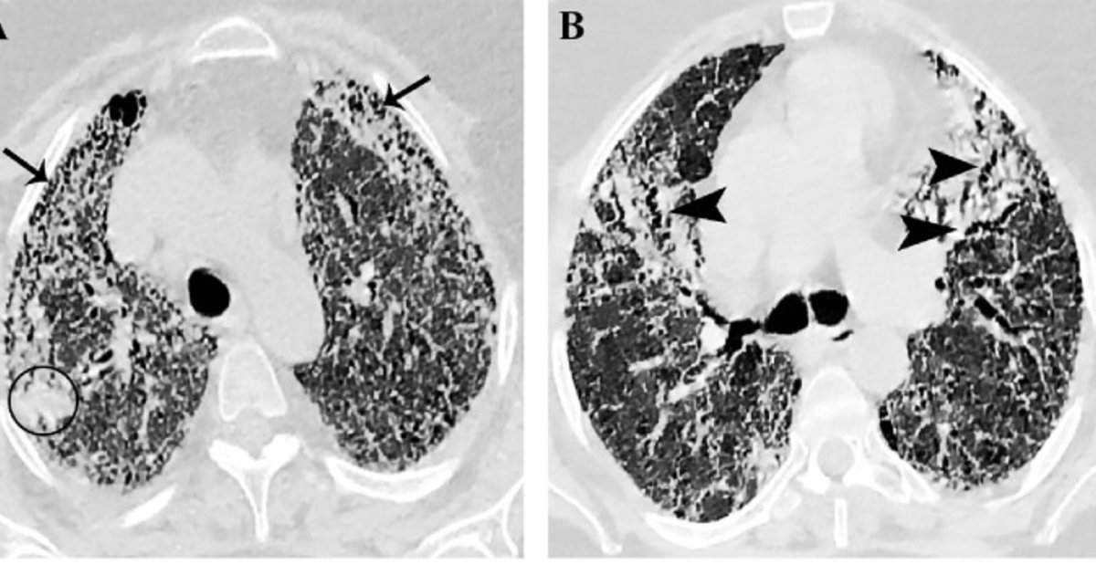 Lung disease reporting system improves consistency—so why is it ...