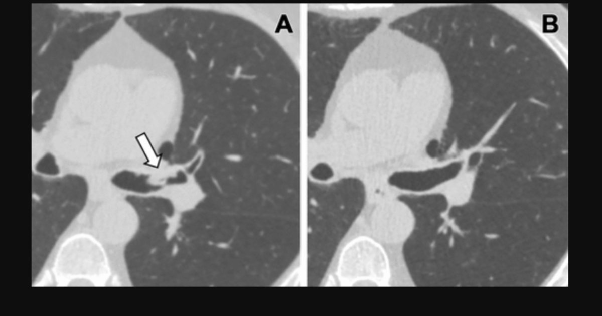 Lung-RADS update helps limit false-positive results, unnecessary procedures