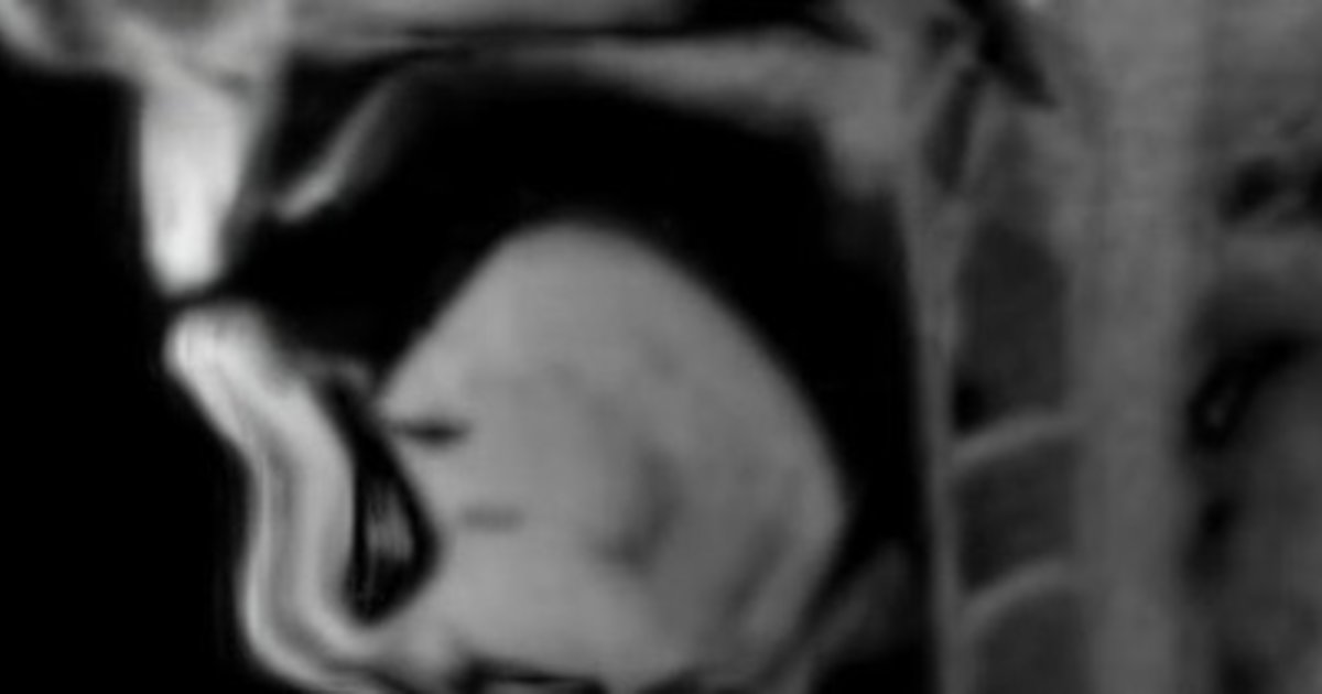 Real-time MRI shows exact mechanisms underlying man's stutter