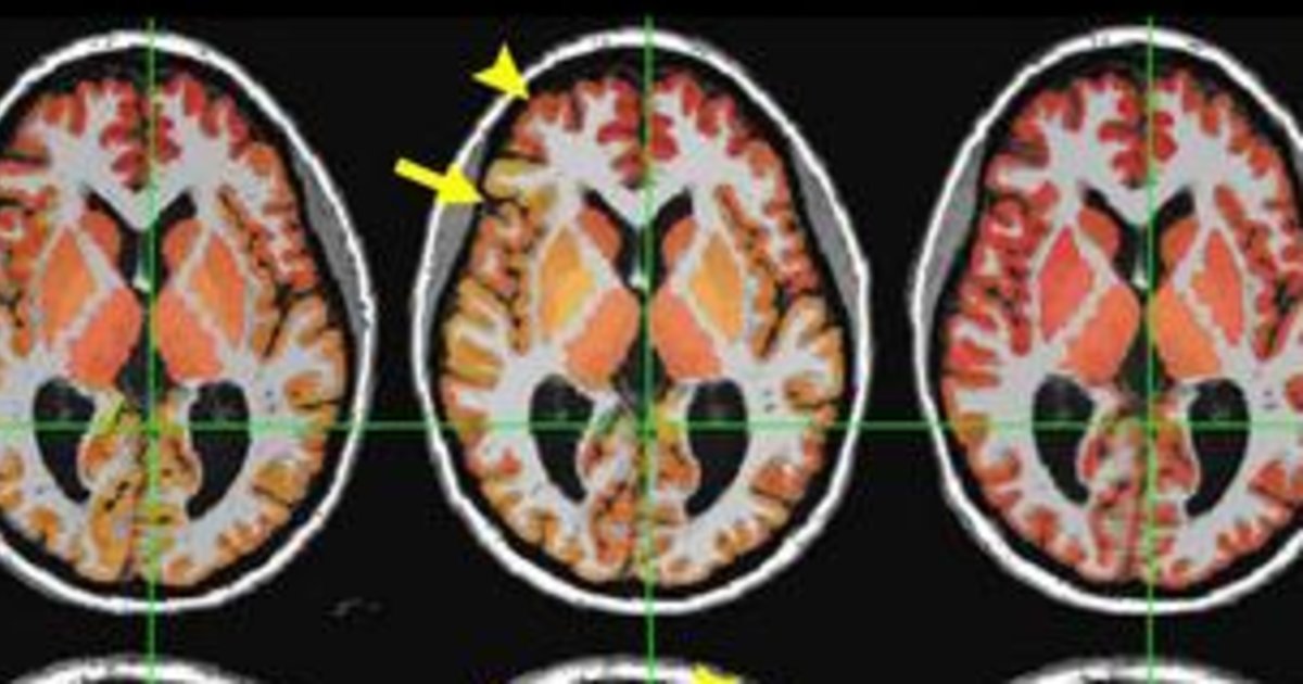 Light therapy improves brain connectivity after head trauma, MRI study ...