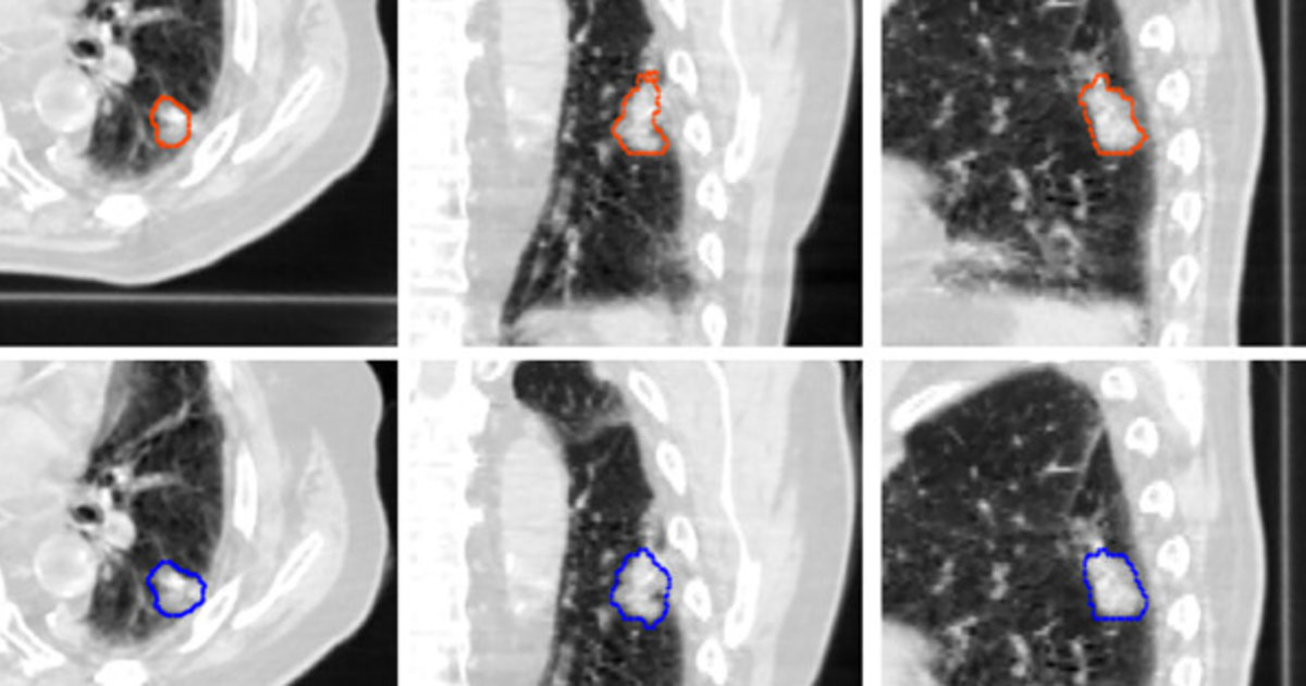 Deep learning model halves lung tumor segmentation times