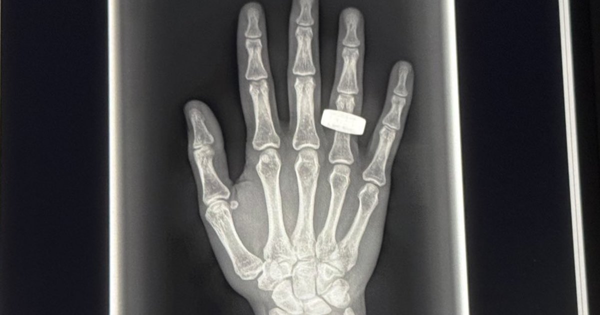 First X-rays taken in space mimic historic first radiograph captured on ...