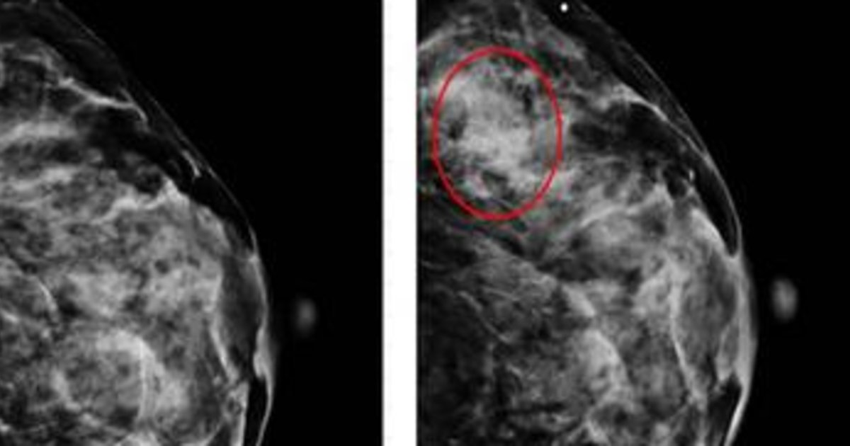 Research links tissue patterns on imaging with breast cancer risk
