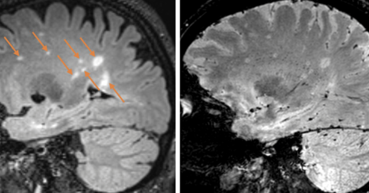 6-minute MRI matches lumbar puncture's accuracy in diagnosing multiple ...