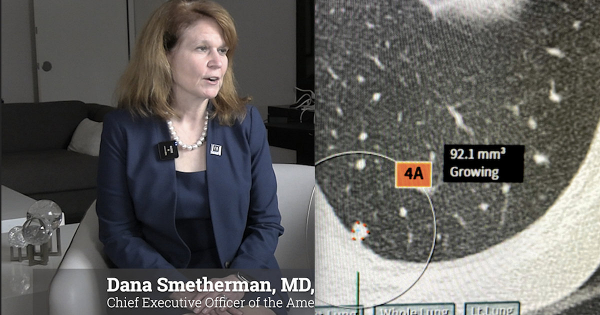 AMA resolution backs expanded low-dose CT screenings for lung cancer ...