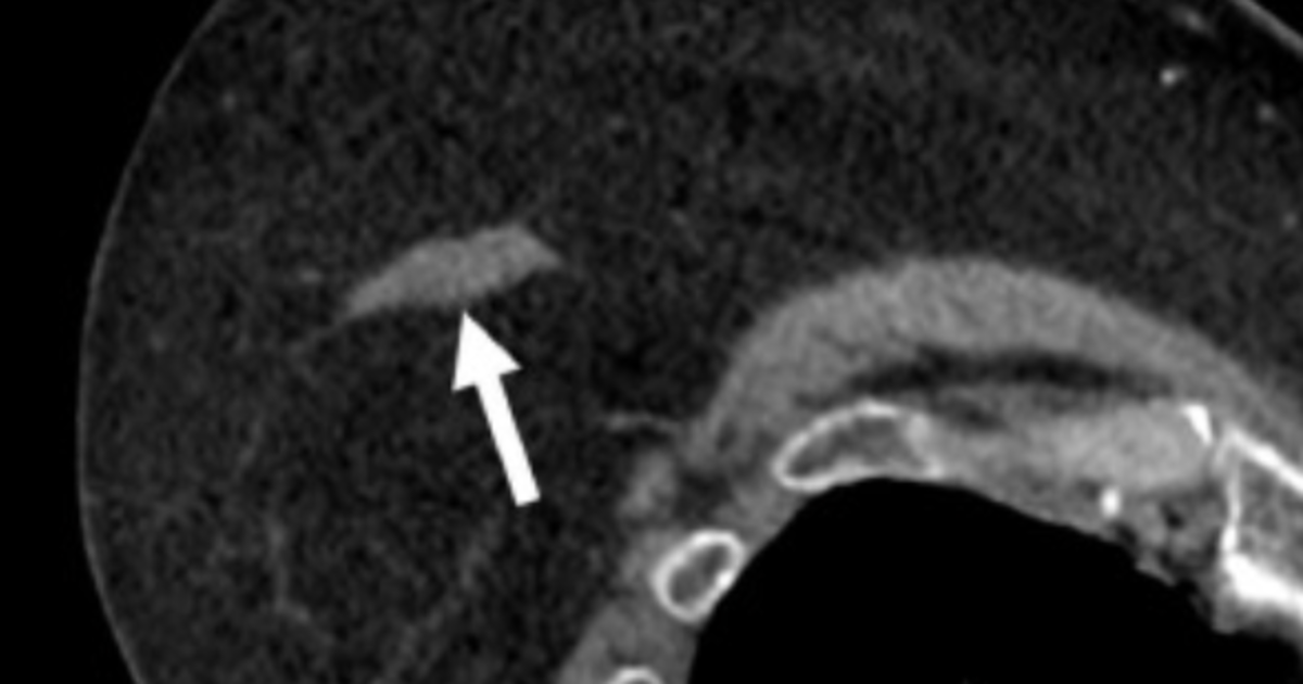 AI detects twice as many incidental lesions as radiologists