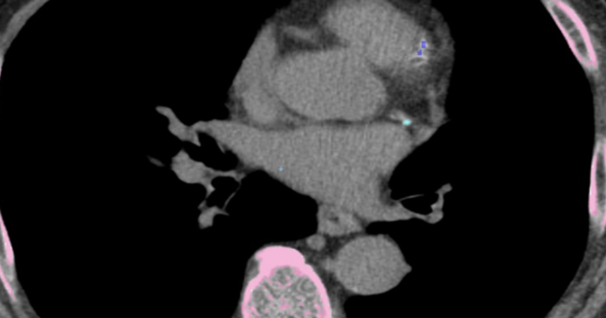 AI enables tracking of coronary artery calcium growth on routine lung ...