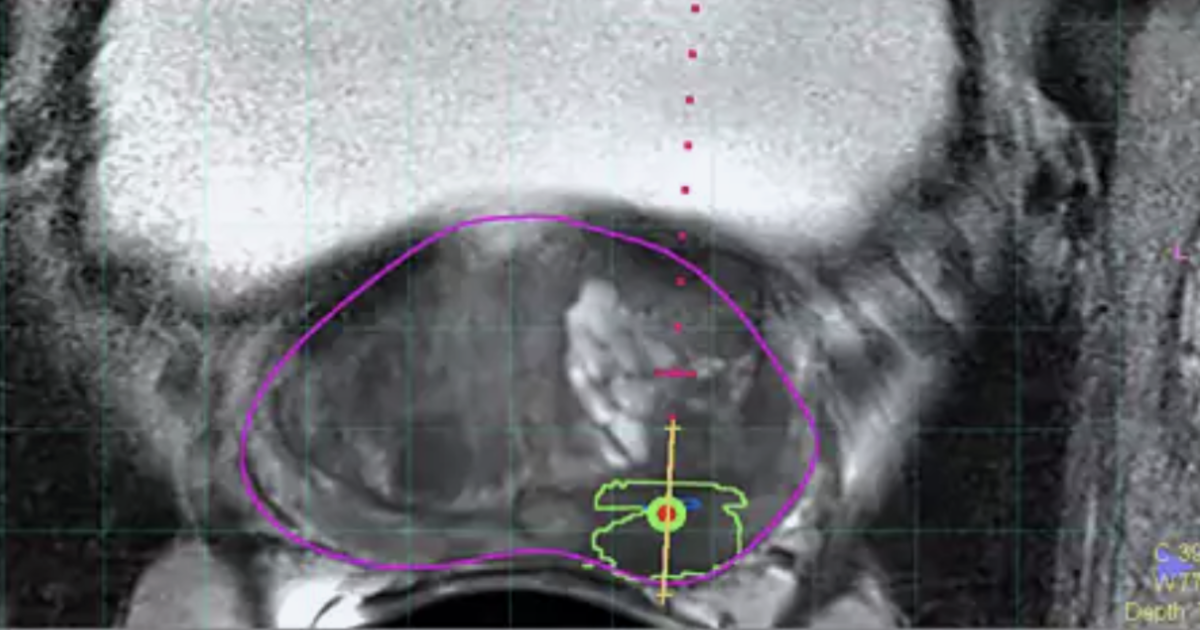 FDA clears fusion image navigation system for prostate cancer therapy ...