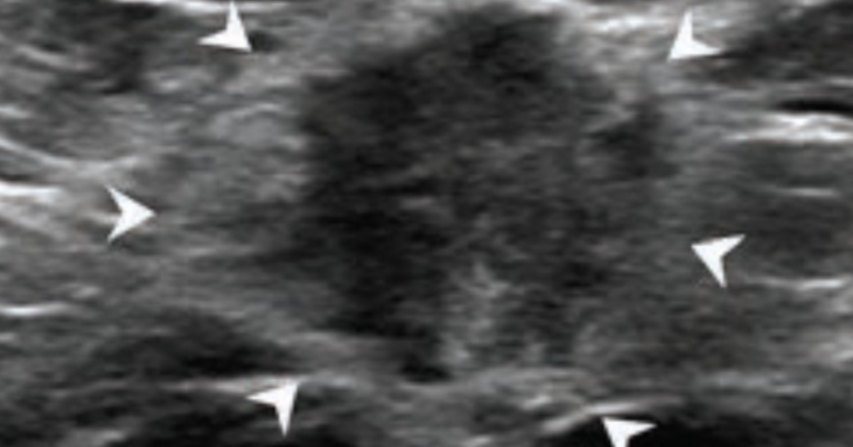 Breast ultrasound finding may signal invasive cancer, research suggests