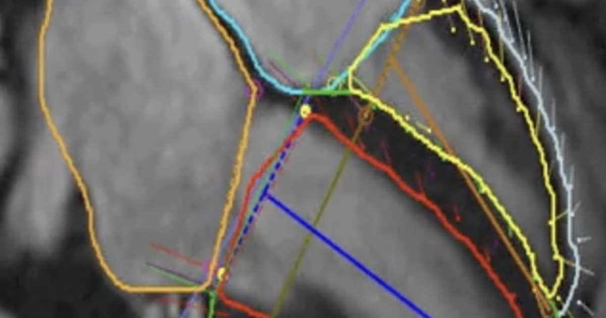 Single MRI finding independently predicts heart failure